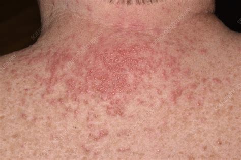 Eczematous Rash On The Back Of A Mans Neck Stock Image C0594146