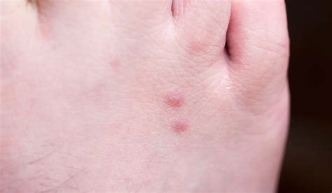 Identifying Bug Bites In Florida Images And Identification Native Pest