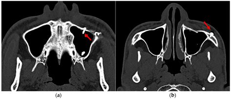 Jcm Free Full Text Risk Factors For Maxillary Sinus Pathology After Surgery For Midfacial