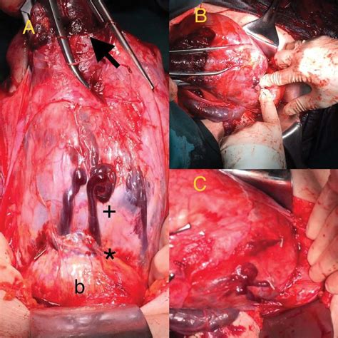 Utilizing Blunt Dissection Technique A Asterisk Indicates