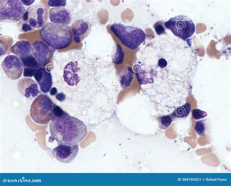 Niemannpick Cells In Bone Marrow Stock Image Image Of Wright Bone