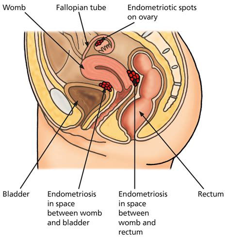 Endometriosis Leeds Teaching Hospitals Nhs Trust
