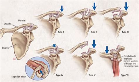 Luxación Acromioclavicular Tratamiento Iqdgvo