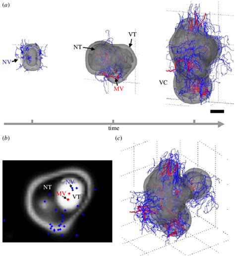 Infiltrative Tumour Morphology Multiscale 3d Computer Model Predicts
