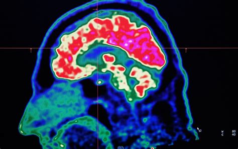 Scans Reveal How Half The Brain Adapts After Other Half Is Removed Epilepsyu
