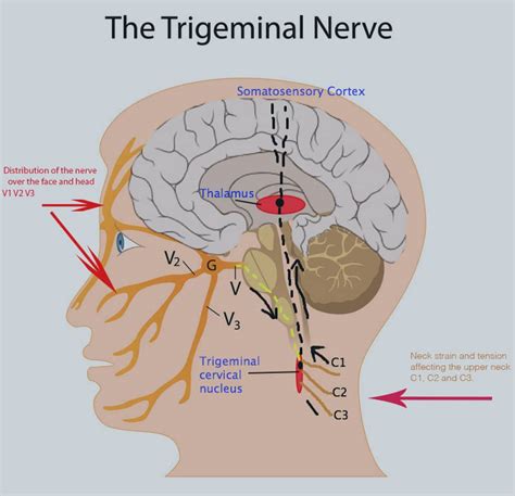 Trigeminal Neuralgia And C3 Subluxation Solutions From A Linwood