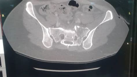 Mahendran Subramaniam On Linkedin Lc1 Fracture In A 24 Yo Lady Foot