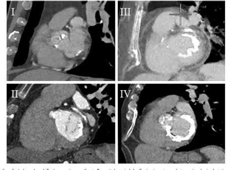 Figure 1 From Extensive Calcification Of The Mitral Valve Annulus In