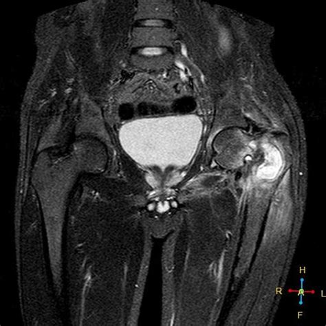 Fibrous Dysplasia Pictures