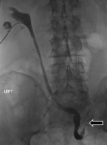Complications Of Ileal Conduits After Radical Cystectomy