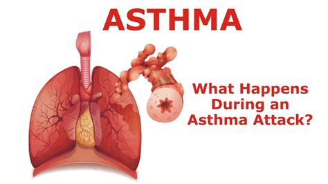 Asthma Attacks Causes Of Asthma In Adults Tefcp