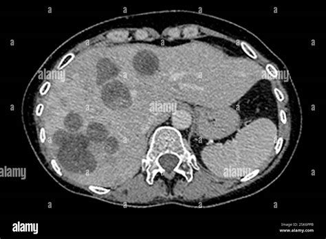 Secondary Liver Cancer Coloured Computed Tomography Ct Scan Of A