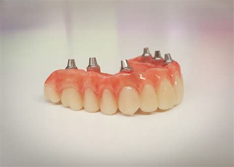 Implant Supported Removable Dentures Fit Right Denture Clinic