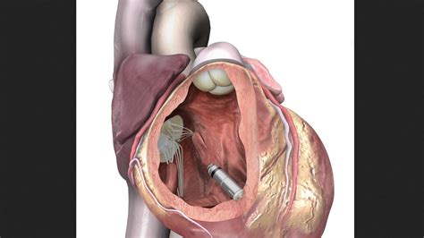 Fda Approves Medtronics Next Generation Micra Pacemakers 51 Off