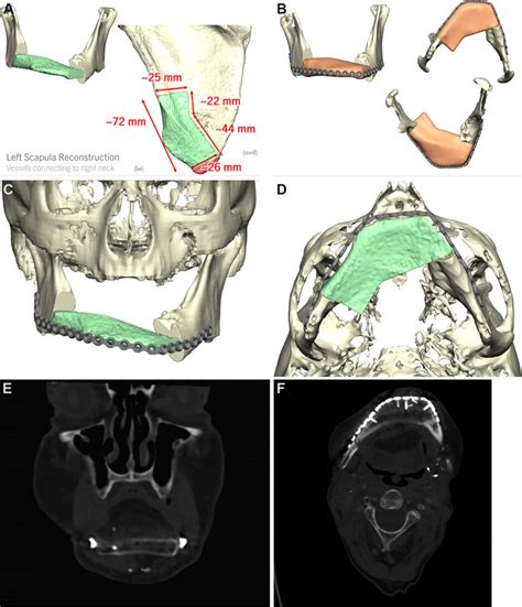 A Individual Patient Solutions Ips Kls Martin Customized
