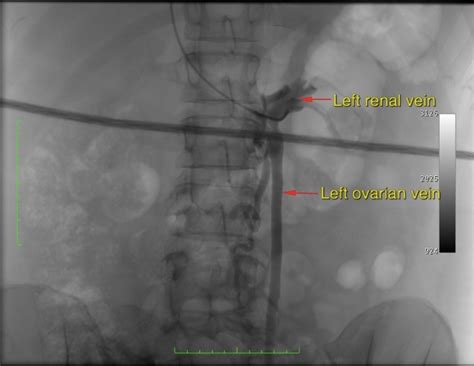 Ovarian Vein Embolisation For Pelvic Venous Congestion Syndrome