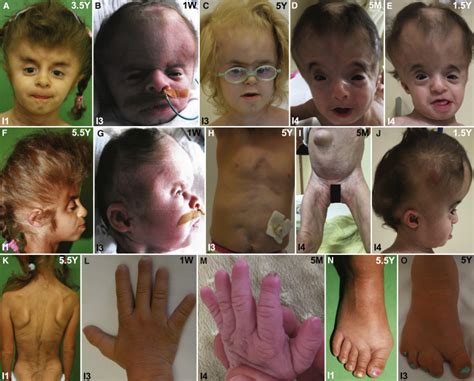 Neonatales Progeroid Syndrom