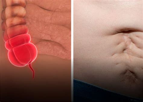 4 Síntomas De Apendicitis Que Podrían Salvarte La Vida De Este Lado Es