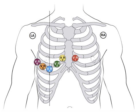 Heart Of The Matter Dextrocardia — Cook County Emergency Medicine