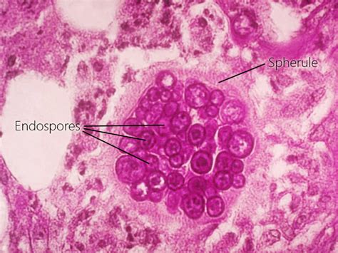 Coccidioidomycosis Spherules Disseminated Coccidioidomycosis With