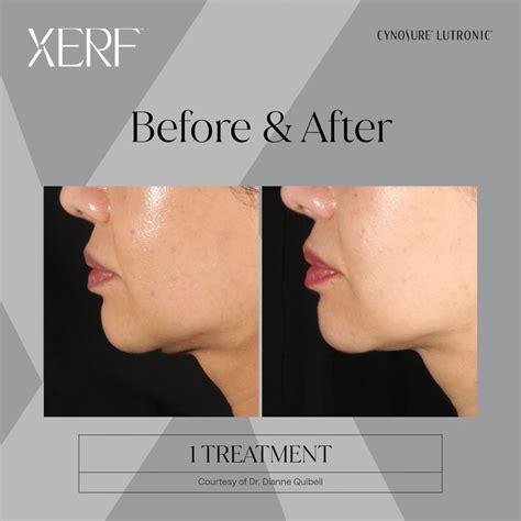 Xerf Treatment Results Before And After Eve Aesthetics