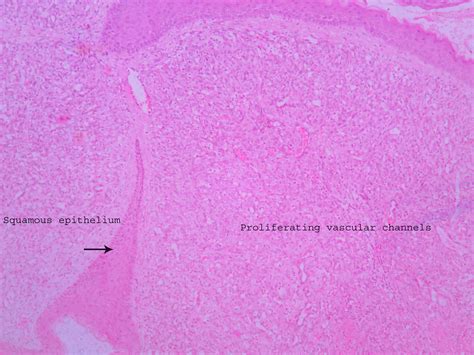 Capillary Hemangioma Histopathology Guru