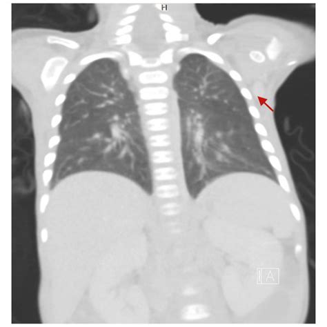 The Lymph Node Effaced And Replaced By A Sheet Of Histiocytes Lymph