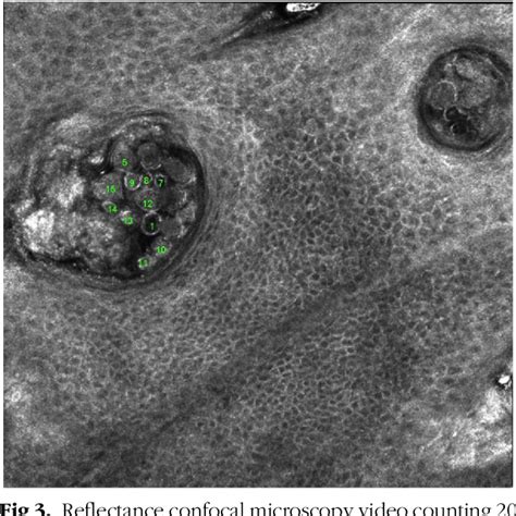 Figure 3 From Pustular Rosacea Secondary To Demodex Infestation Shown