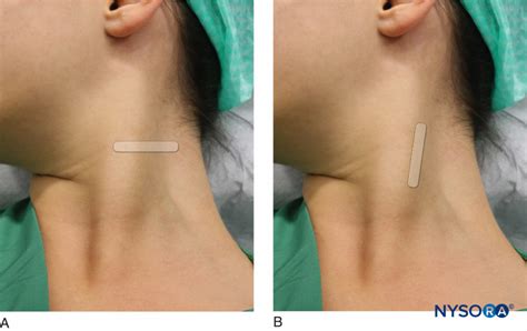 Ultrasoundguided Cervical Plexus Block Nysora