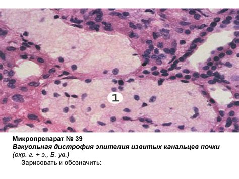 Вакуольная дистрофия эпителия извитых канальцев почки - презентация онлайн
