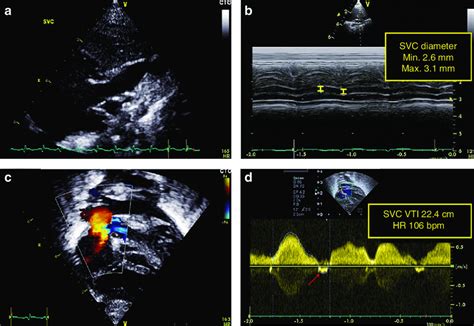 Assessment Of Superior Vena Cava Svc Flow The Svc Diameter Is