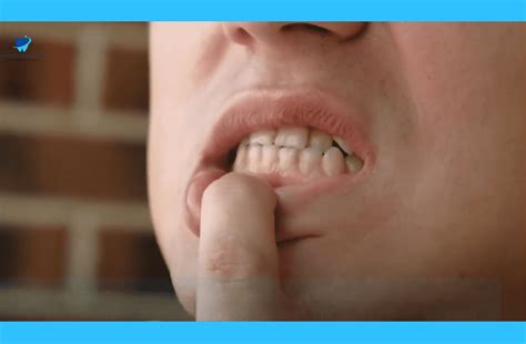 What Is Hypocalcification Teeth All You Need To Know