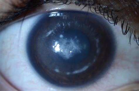 Managing Cross Linking Complications