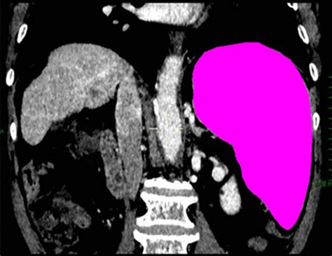 Before Partial Splenic Embolization The Spleen Volume Was 178679 Cm³