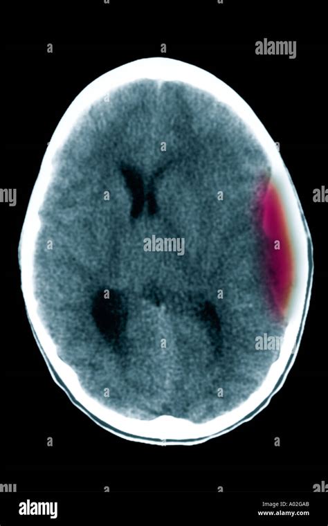 Epidural Hemorrhage