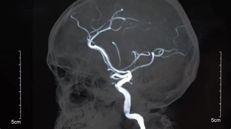 Qué Es Un Aneurisma Cerebral El Mal Silencioso Que Puede Provocar Un Acv Infobae