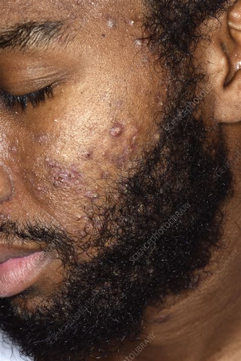 Dissecting Cellulitis Stock Image C060 1245 Science Photo Library