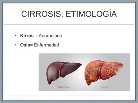 Cirrosis Hepática E Hipertensión Portal Complicaciones Ascitis