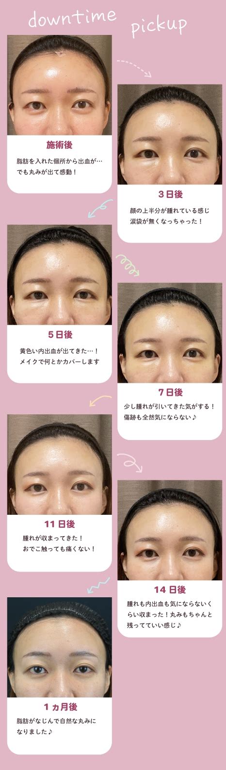 【顔の脂肪注入】ダウンタイム徹底解説🔥岐阜の名医が叶える自然な仕上がり 岐阜院