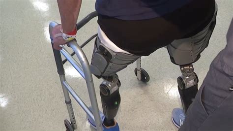 Arkansas Woman Learning To Walk Again With High Tech Prosthetics After
