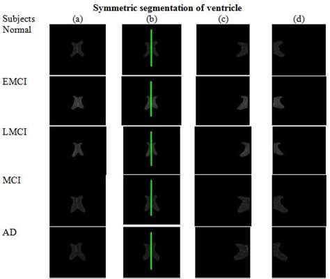 Symmetric Segmentation Of Ventricle A Ventricle Region B Symmetric