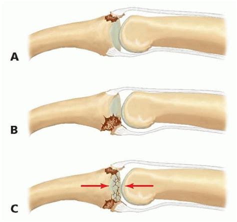 Open Reduction And Internal Fixation Of Proximal Interphalangeal Joint Fracture Dislocations