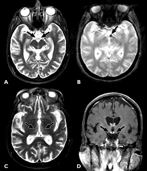 Neuroimaging Findings In Alcohol Related Encephalopathies Ajr