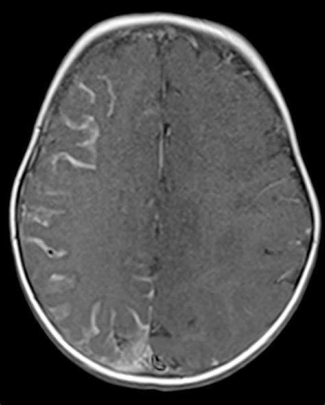 Compva Vascular Malformations Associated With Other Anomalies