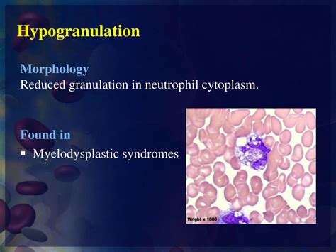 Ppt Wbcs And Plt Abnormal Morphology Powerpoint Presentation Free