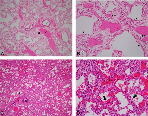 Infants With Atypical Presentations Of Alveolar Capillary Dysplasia