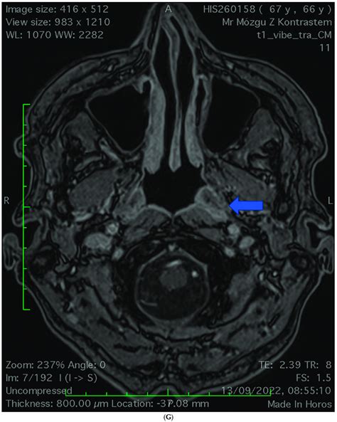 A Patient 1 The Initial Stage Of The Disease Ct Scan