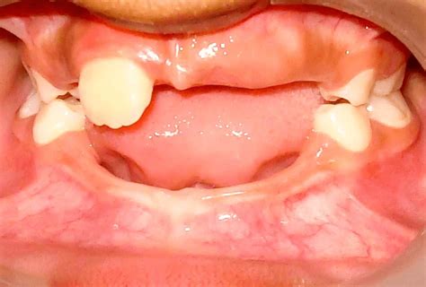 What Is The Difference Between Hyperdontia Hypodontia Oligodontia And