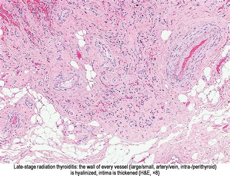 Pathology Outlines Radiation Thyroiditis