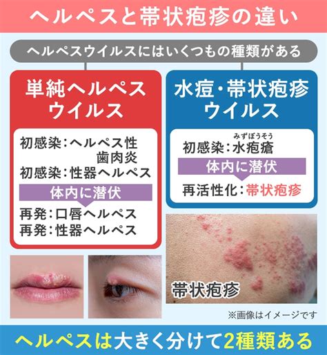 性器ヘルペス感染症の原因・感染経路・検査・治療薬｜池袋マイケアヒルズタワークリニック